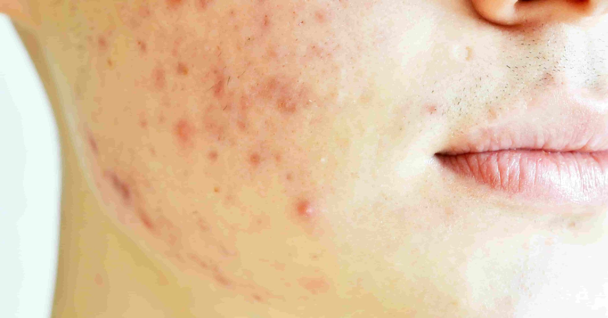 Bacterial Acne: Causes and effective ways to prevent it