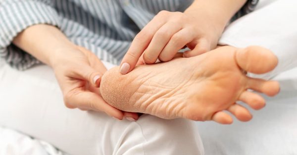 Top 5 ways to manage Dry and Dead skin on the feet