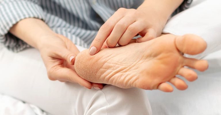 Top 5 ways to manage Dry and Dead skin on the feet