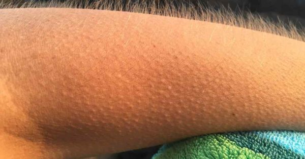 Goosebumps on the skin? Here are the Top 5 major causes and treatment