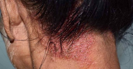 Top 7 Causes And Ways To Treat Scaly Skin